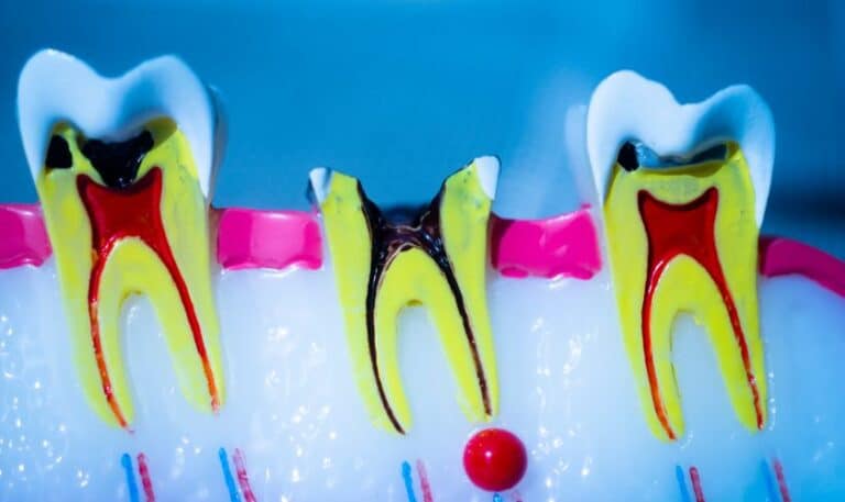 Root Canal Recovery: Tips for a Smooth Healing Process